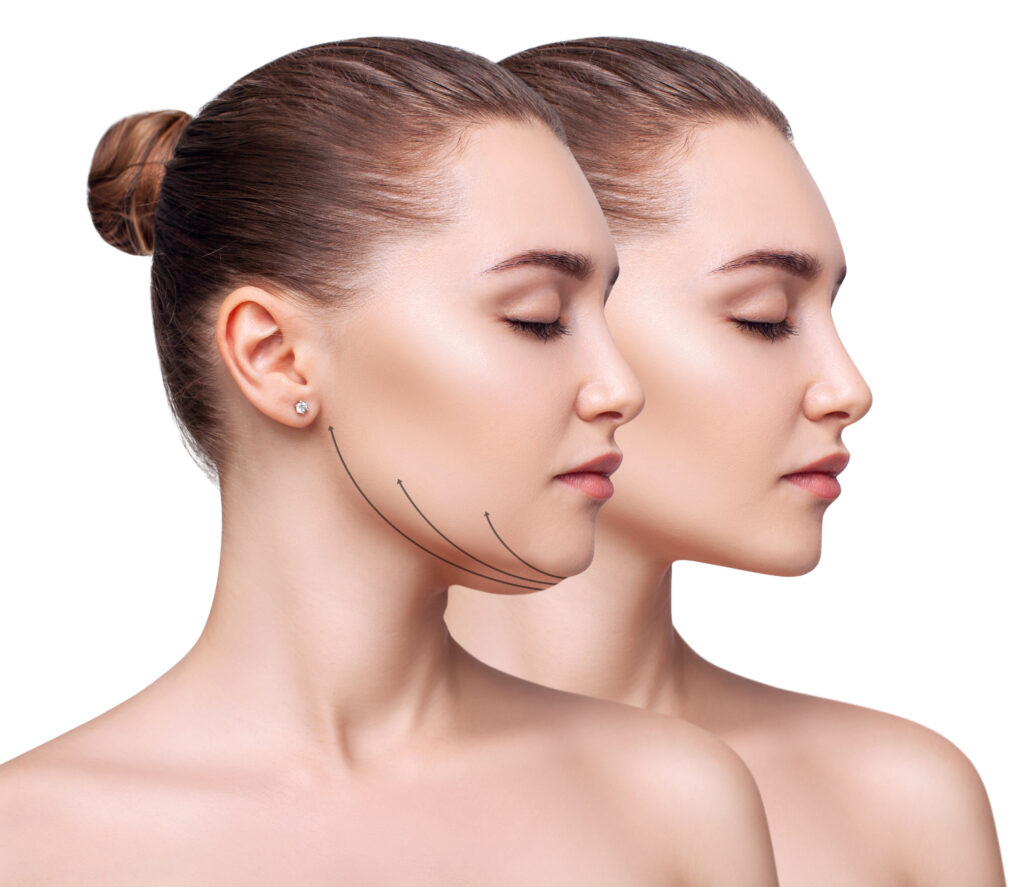 Sculptra To Treat Volume Loss And Sagging Skin Evexias Medical Centers